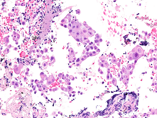Pulmonary Pathology Society